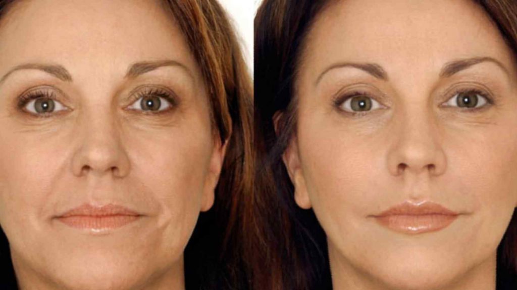 Before + After Gallery - Aesthetic Body Design